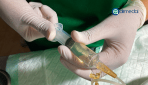 Ascitis: qué es, síntomas, causas y tratamiento