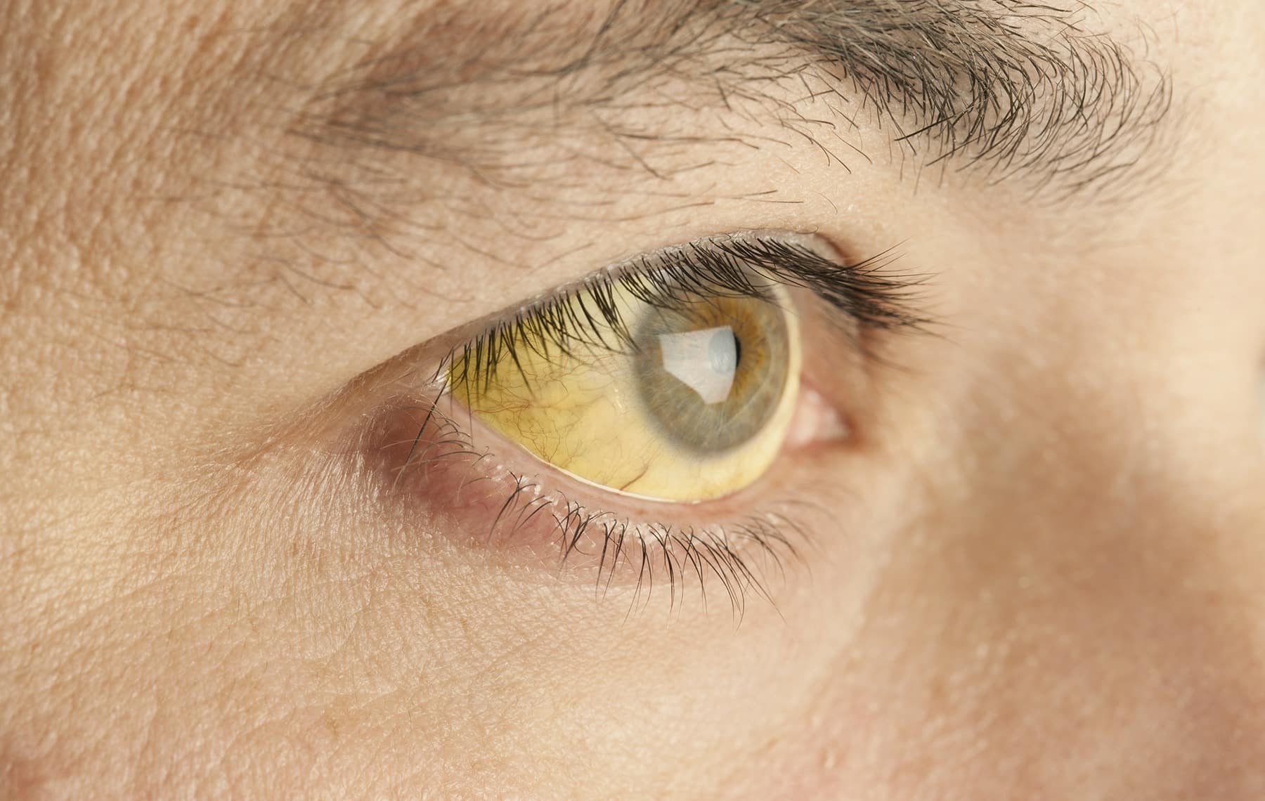 10 enfermedades que te ponen “amarillo” - Dirmedal - Directorio Médico ...