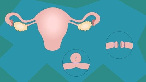 5 Peligros De La Salpingoclasia O Ligadura De Trompas Dirmedal
