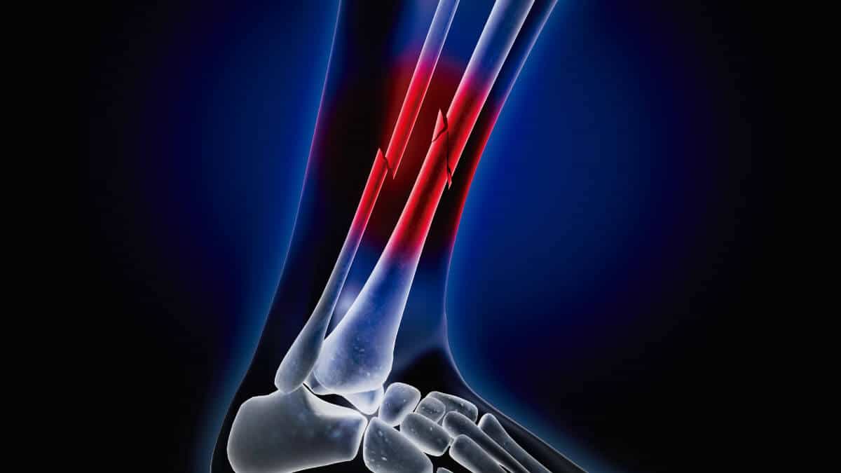 5 señales que confirman que te fracturaste - Dirmedal - Directorio ...